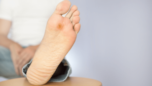What's the Difference B/W Plantar Fasciitis & Bruised Heel?